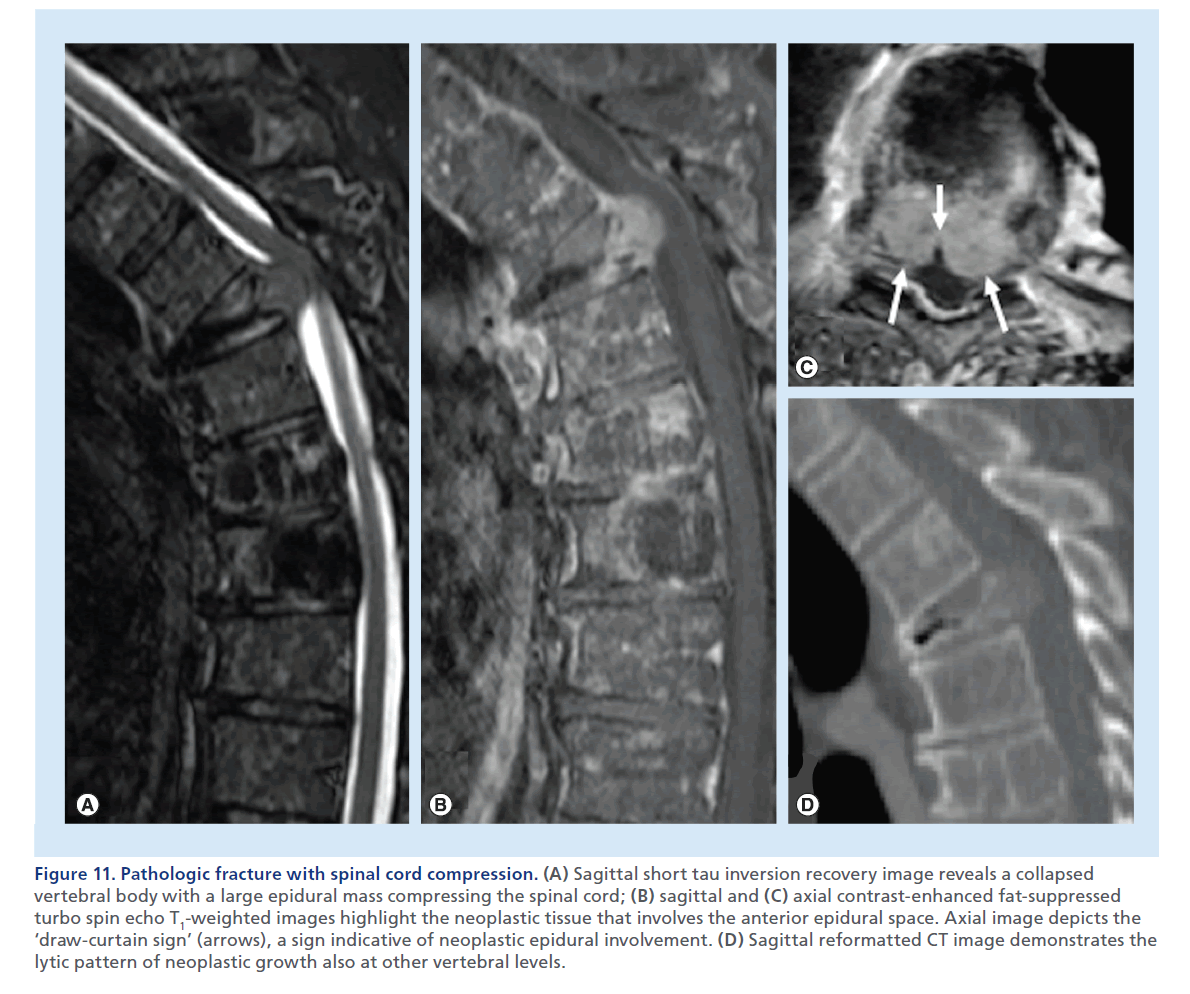 Imaging of spinal cord compression