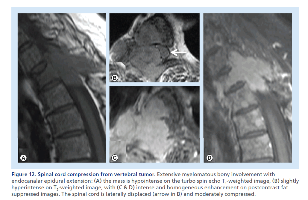 Cord Compression Mri Protocol at Leah Crisp blog