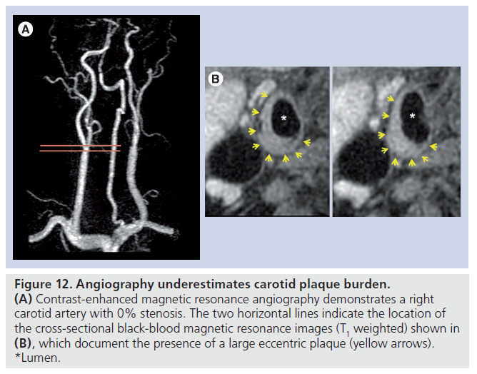 MRI in the early identification and classification of high-risk a