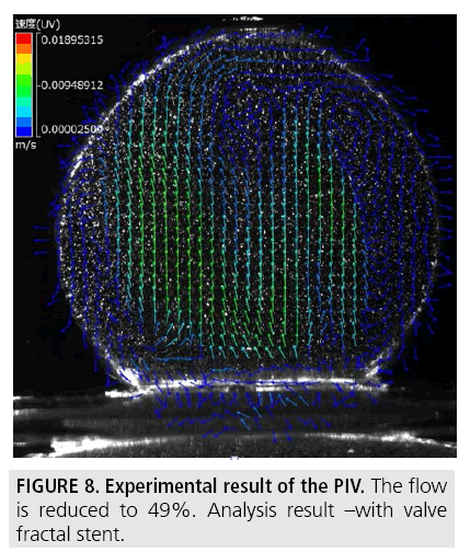 The study of valve hybrid fractal stent for the next generation b