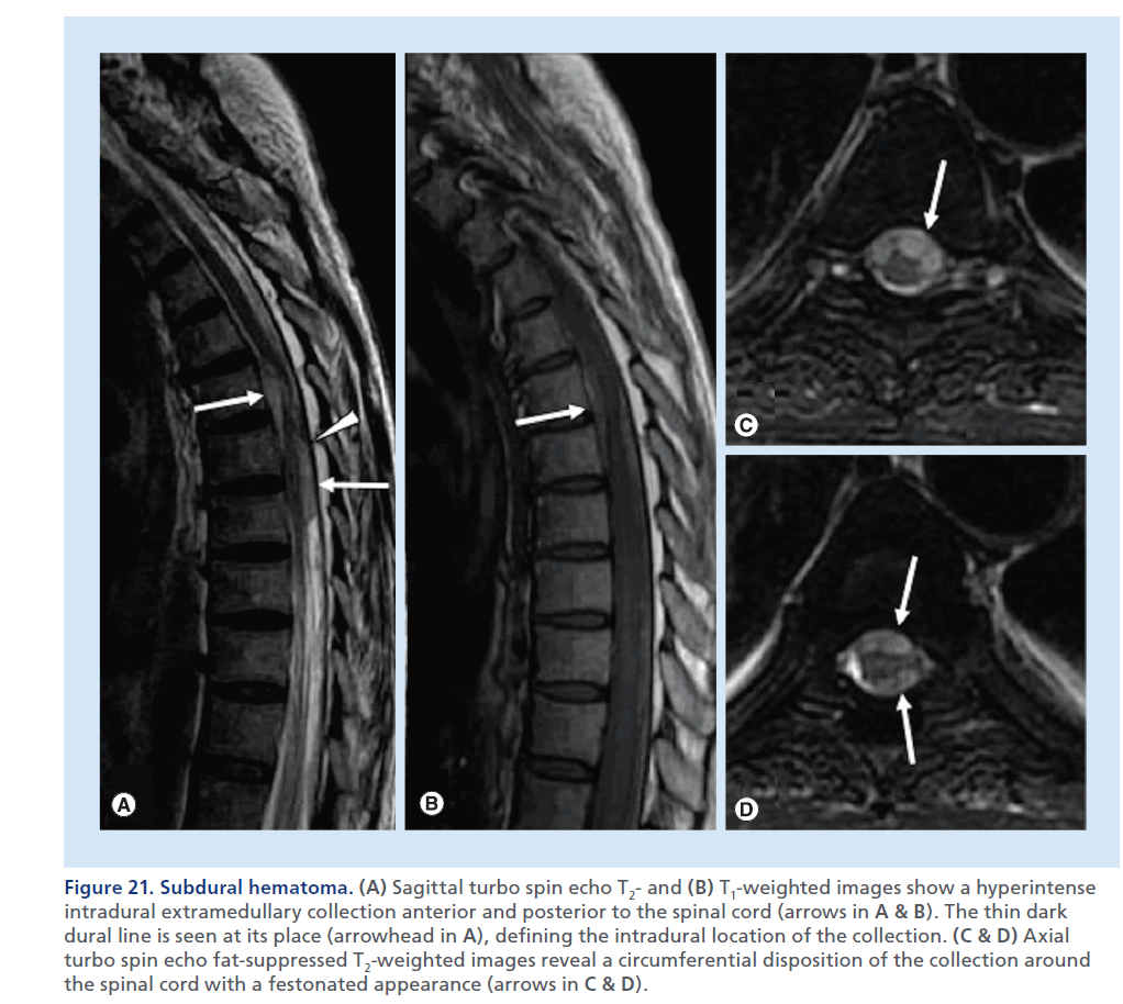 Imaging of spinal cord compression
